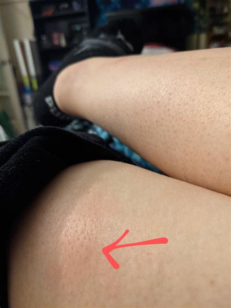 Slightly Raised Honeycomb Rash On My Thigh Very Itchy And While Typing