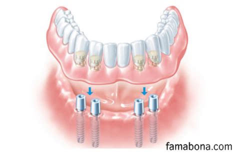 зъбни протези