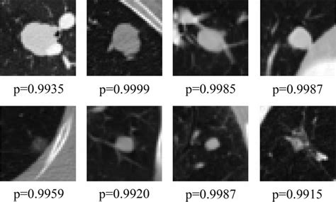 Examples Of Pulmonary Nodule Detection Results Of Our Framework Each