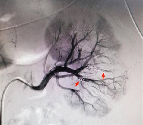 Multiple Super Selective Renal Angiographic Embolization Jir