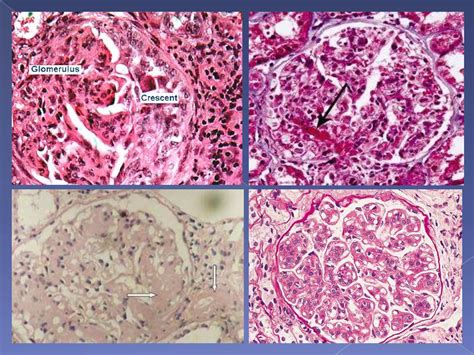 Interpretation Of Renal Biopsy Pptx