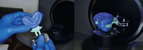 Digital Denture Workflow For A Fully Edentulous Patient Dental Asia