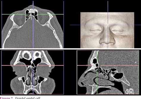Figure 2 From Frequency Of Frontal Cells According To The International Frontal Sinus Anatomy