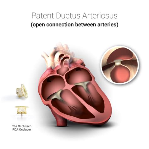 Occlutech Pda Occluder Occlutech Every Beat Counts