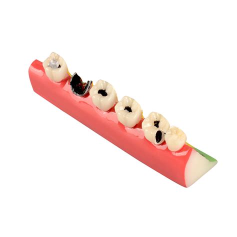 Tooth Decay Development Model 5 Dental Caries Stages