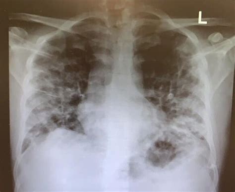 B A Chest X Ray Of The Same Patient Two Weeks Later Shows Bilateral