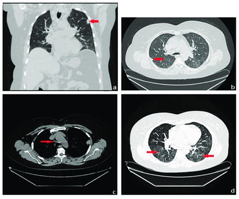 A Chest Ct Was Performed Which Revealed Subpleural Micronodular And