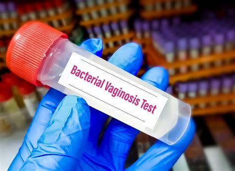 Bacterial Vaginosis Bv Bv Tests Broadgate Gp