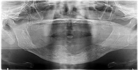 X Ray After Decompression And Cystic Enucleation Download