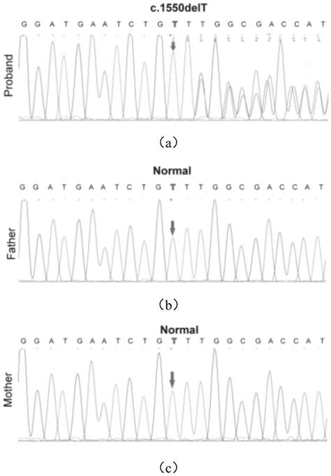 Cranial Clavicle Dysplasia Pathogenic Runx2 New Mutation Site Gene Polypeptide And Application