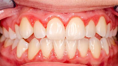 Swollen Gums Reveal These 7 Things About Your Health Power Of Positivity