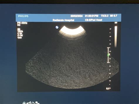 Philips C8 5 Broadband Curved Array Ultrasound Transducer Probe Auschoice