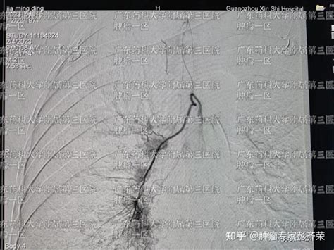 肺癌淋巴结转移做手术还有意义吗?是不是只能等死了 知乎 肺癌淋巴结转移做手术还有意义吗?是不是只能等死了 知乎