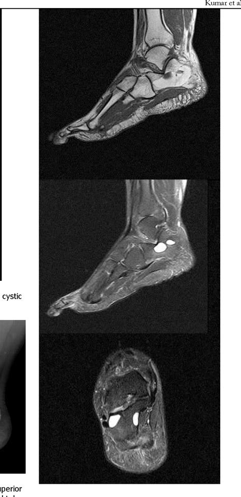 Figure 3 From Intraosseous Calcaneal Lipoma With Subtalar Perforation Through Cystic