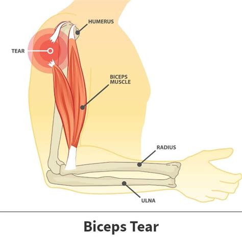 Bicep Tenodesis Florida Orthopaedic Institute Bicep Tear Exercises