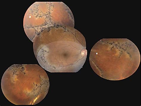 Paravenous Chorioretinal Atrophy Semantic Scholar