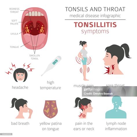 Tonsils And Throat Diseases Tonsillitis Symptoms Treatment Icon Set