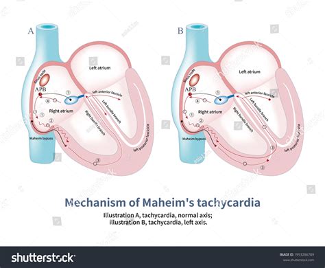 Qrs Wave Complete Left Bundle Branch Stock Illustration Shutterstock