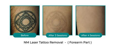 Best Laser Tattoo Removal In Malaysia Nextmed Clinic
