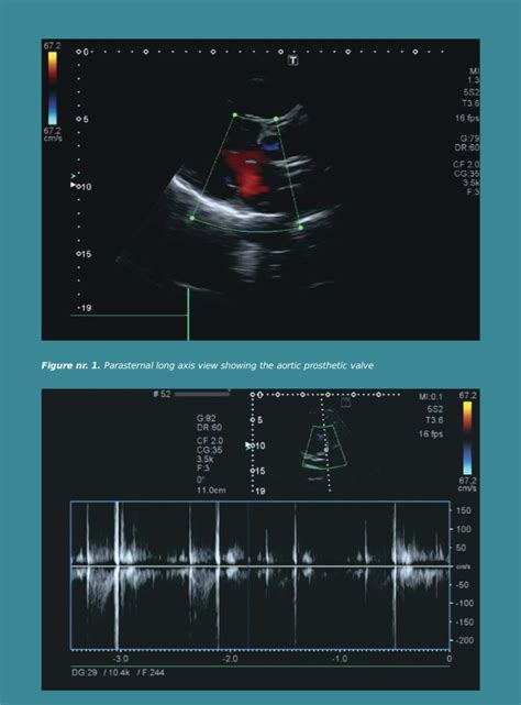 Figure Nr 2 Continuous Wave Doppler Showing The Aortic Prosthetic