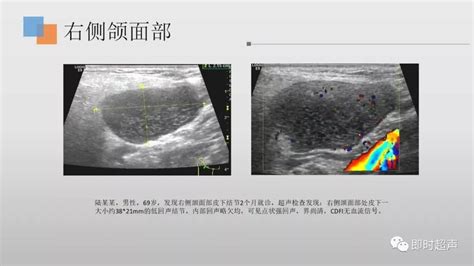 表皮样囊肿的超声诊断 搜狐大视野 搜狐新闻