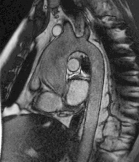 Ssfp Mra Questions And Answers In Mri