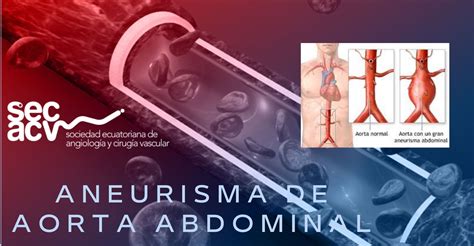 Aneurisma De Aorta Abdominal Secacv