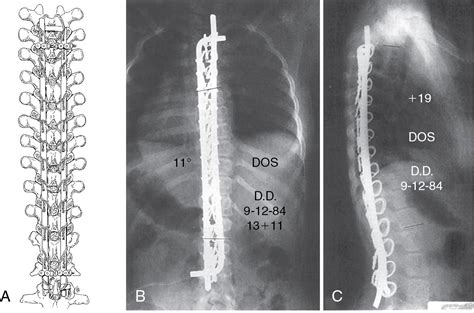 Thoracic And Lumbar Spine Instrumentation Clinical Tree