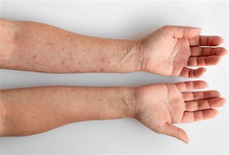 Ulkus Dekubitus Adalah Luka Pada Kulit Kenali Gejala Dan Penyeba