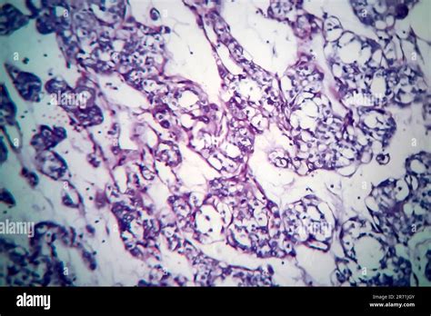 Thyroid Follicular Carcinoma Light Micrograph Photo Under Microscope