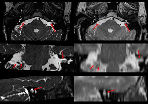 10th Cranial Nerve Mri