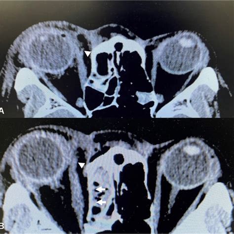 A Preoperative Axial Computed Tomography Ct Of The Orbit Showing Download Scientific Diagram