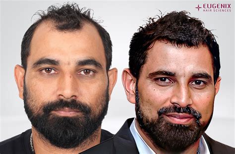 Mohammed Shami Norwood Class 5v Hair Transplant Results And Hair