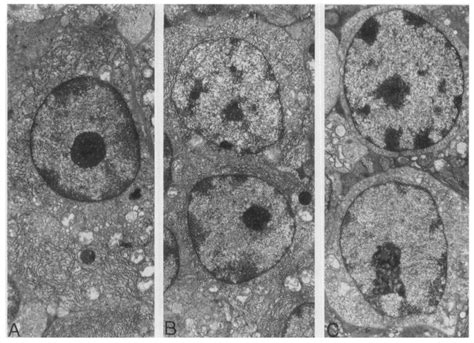 Ultrastructural Spectrum Of Plasmacytoid Differentiation A The Cell
