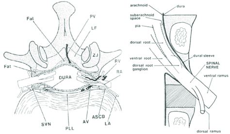 The Nerve Roots Are Enclosed In Their Dural Sleeve Which Is Surrounded