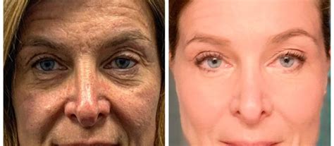 Is Fibroblast Better Than Botox Coastal Longevity Institute