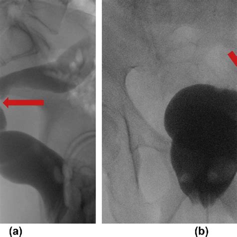 Cect Post Laparoscopic Anterior Resection And Loop Ileostomy Dilated