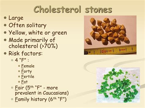 Cholesterol Gallstone At Sebastian Bardon Blog