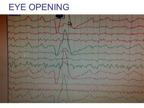 Artifacts And Normal Variants In Eeg