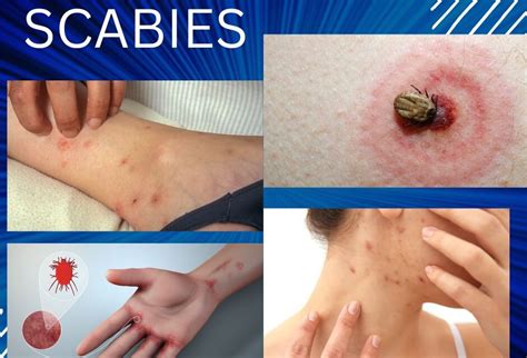 Crusted Scabies On Elbow