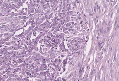 Malignant Pleural Effusion Icd Code