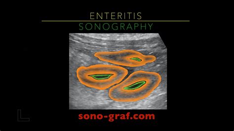 Sonography Enteritis Youtube