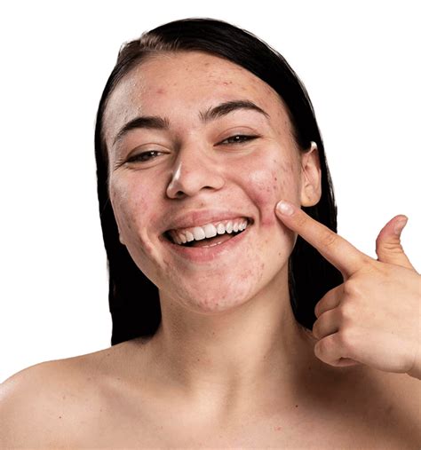 Breakout And Blemishes