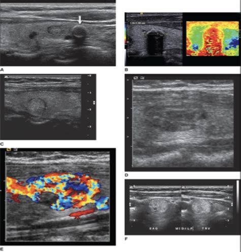 Thyroid Gland Flashcards Quizlet