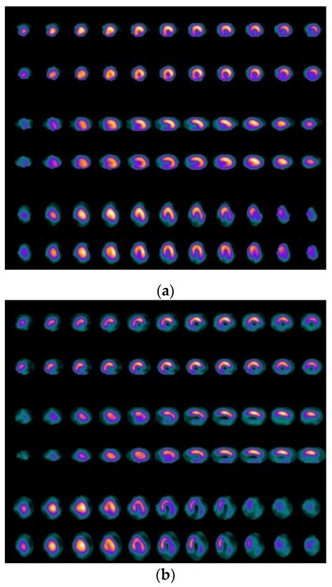 Ischemia Myocardial Perfusion