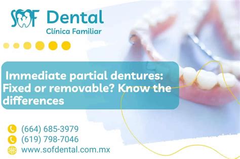 Immediate Partial Dentures Fixed Or Removable Know The Differences SOFDental Dentistas En