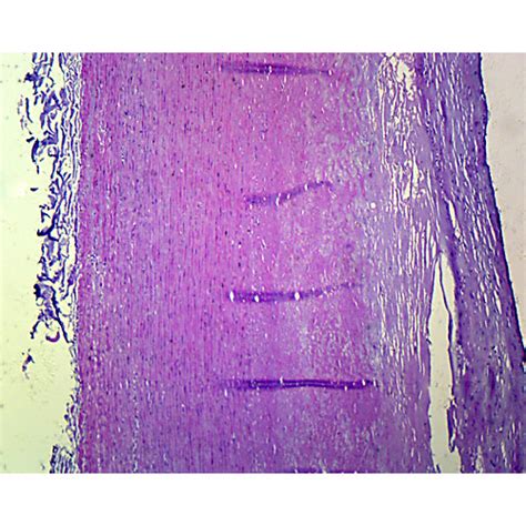 Prepared Microscope Slideatherosclerosis Human Coronary Artery