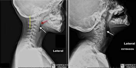 What Is Pseudosubluxation Of The Cervical Spine Dawp
