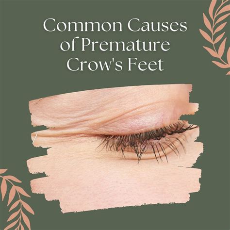 Common Causes Of Crows Feet Crows Feet Skincare Habits Skincare