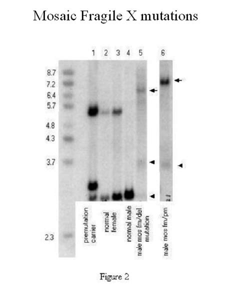 Mosaic Fragile X Mutations Southern Blot Using Probe Stb123 On Ecor1
